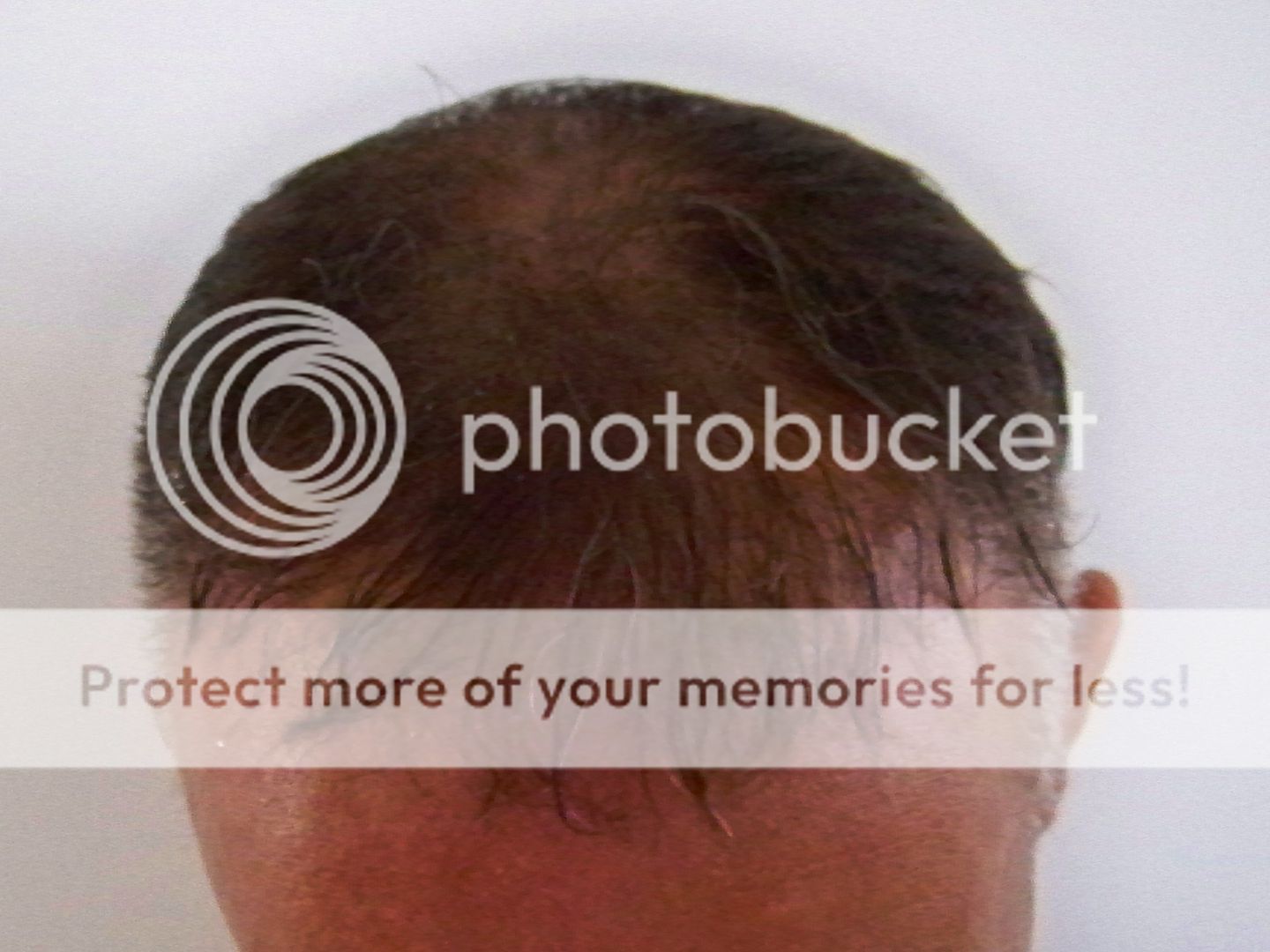 Should I Use Nape Hair For My Hairline? [pics] | HairLossTalk Forums